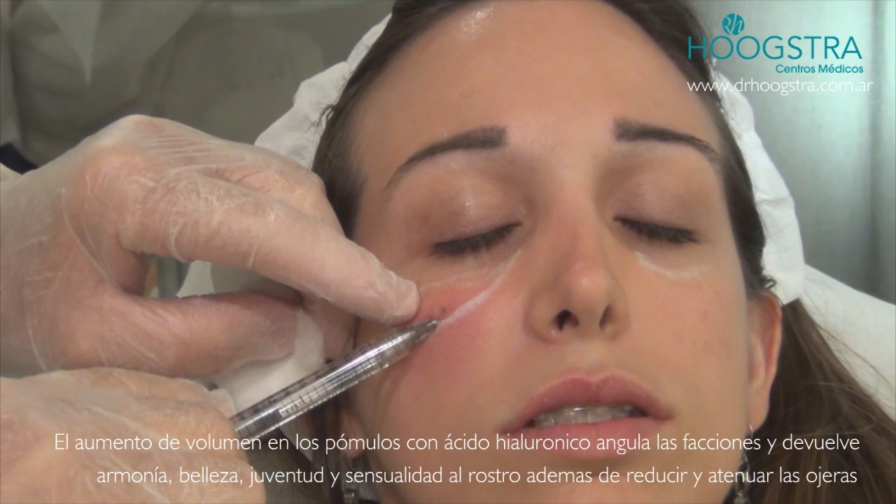 Ojeras - Tratamientos láser/ácido hialurónico - Hoogstra Buenos aires