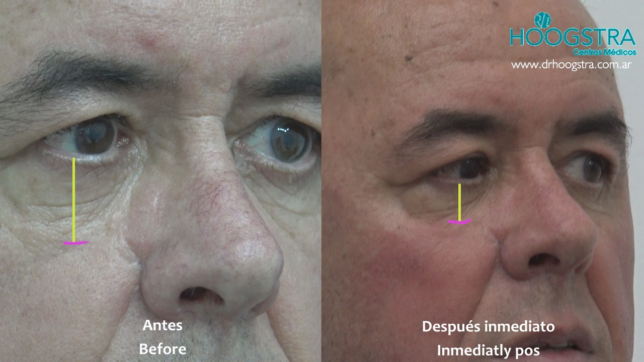 [:es]Lifting de párpados sin cirugía - Operación de párpados caídos ...