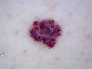 Imágenes de angioma de cereza - Hoogstra - Centros Medicos