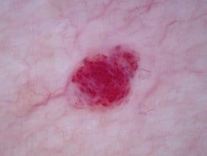 Imágenes de angioma de cereza - Hoogstra - Centros Medicos