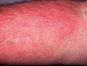 Imagens de dermatite alérgica de contato em braço e perna - Hoogstra ...