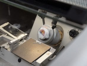 Mohs micrographic surgery - Hoogstra - Medical Centers