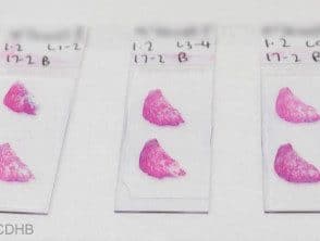 Mohs micrographic surgery - Hoogstra - Medical Centers