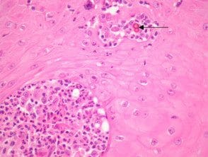 Patología de la cromoblastomicosis - Hoogstra - Centros Medicos