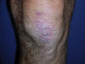 Imágenes de psoriasis en placa crónica - Hoogstra - Centros Medicos