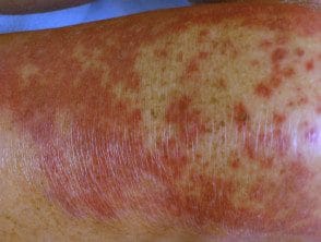 Dermatitis de contacto - Hoogstra - Centros Medicos