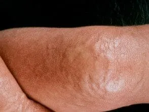 Mastocitosis - Hoogstra - Centros Medicos