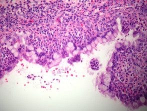 Patología del quiste del rafe mediano - Hoogstra - Centros Medicos