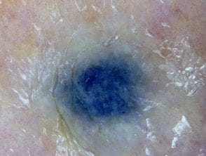 Imágenes de melanoma metastásico - Hoogstra - Centros Medicos