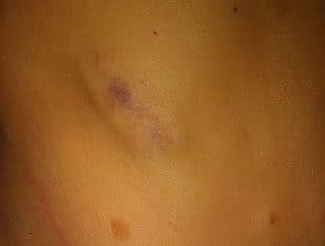 Melanoma metastásico - Hoogstra - Centros Medicos