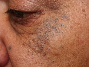 Comedón - Hoogstra - Centros Medicos