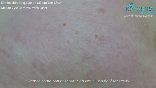 Milium Cyst Treatment - Hoogstra - Medical Centers